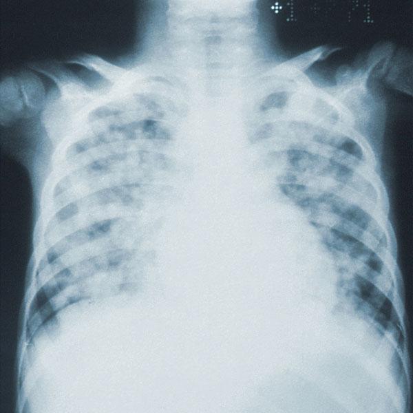 How to Set Broken Bones in an Emergency – Ready Store
